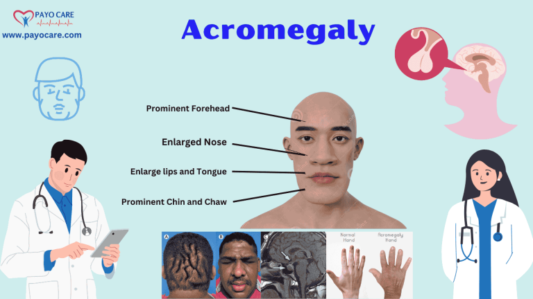 Acromegaly: Types, Causes, Symptoms & Treatment – PAYO CARE provides ...