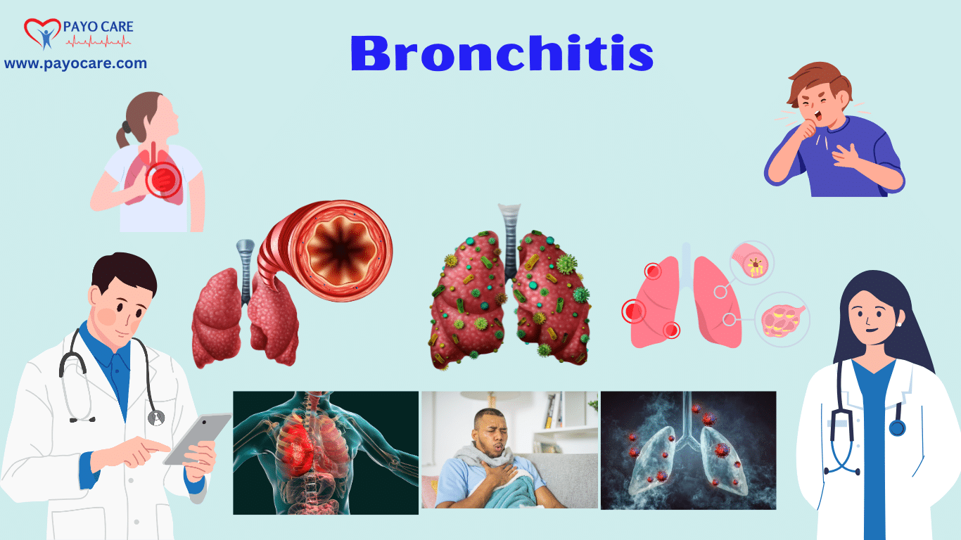 Bronchitis: Causes, Symptoms, Treatment & Prevention - Payo Care