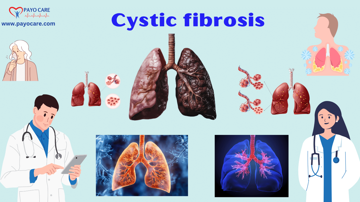 Cystic Fibrosis: Causes, Symptoms, Prevention & Treatment - Payo Care