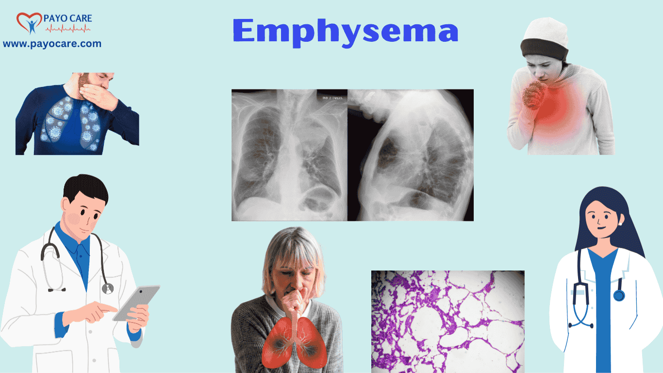 Emphysema: Causes, Symptoms & Treatment – PAYO CARE provides expert ...