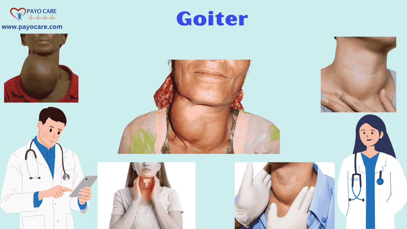 Goiter: Causes, Symptoms and Treatments - Payo Care