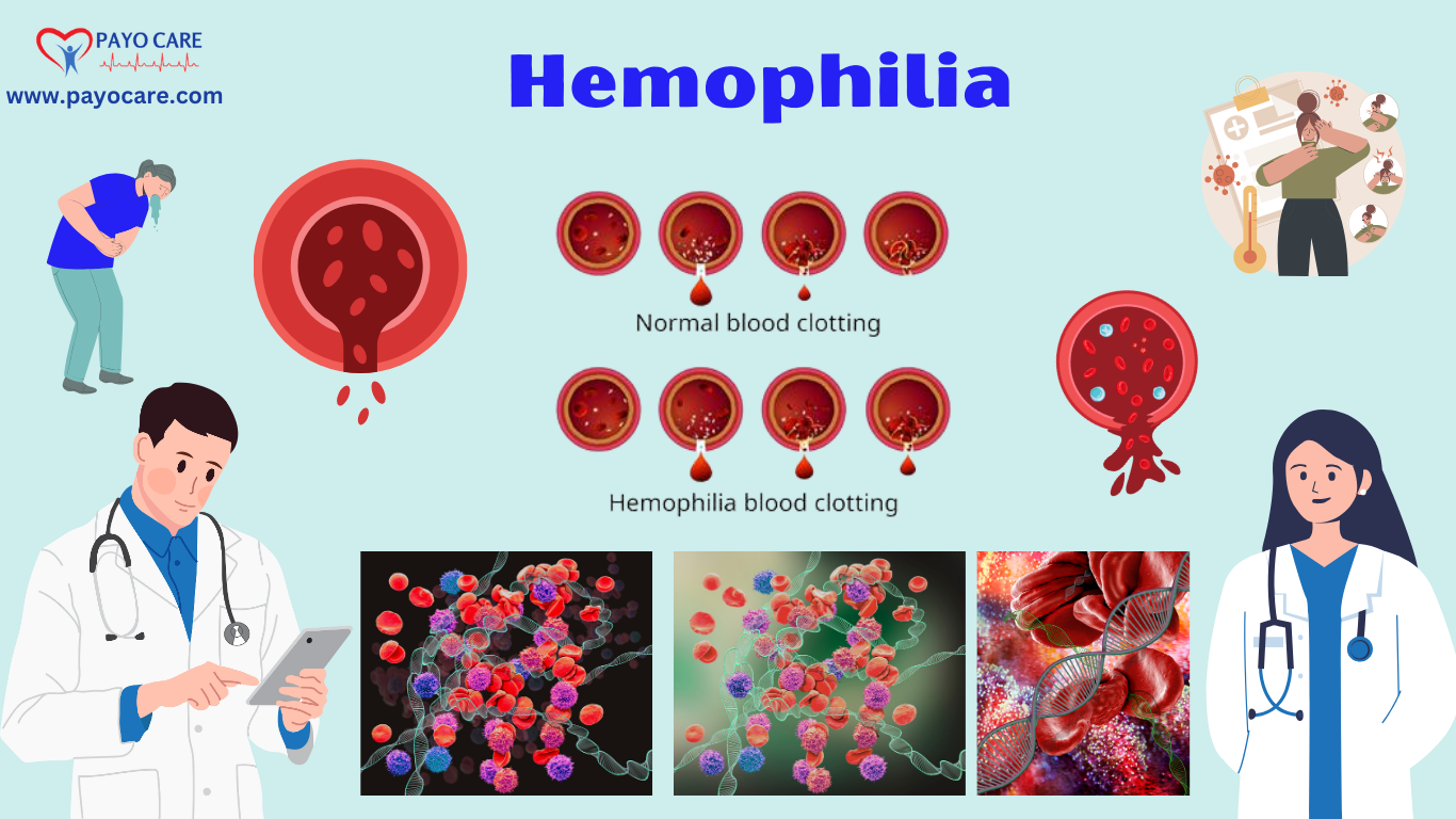 Hemophilia: Causes, Symptoms, Prevention & Treatment - Payo Care