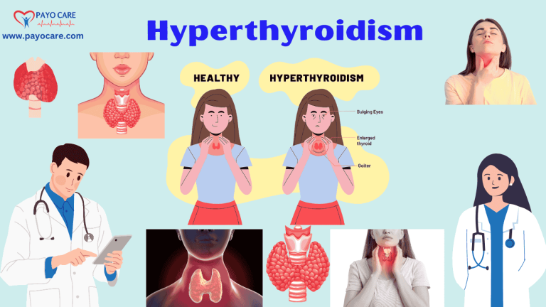 Hyperthyroidism: Types, Causes, Symptoms & Treatment – PAYO CARE ...
