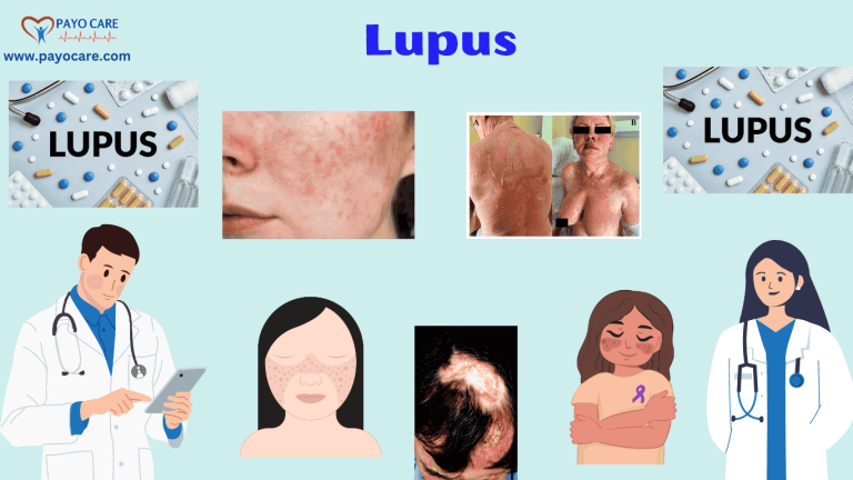 Lupus :Causes, Symptoms, Prevention & Treatment - Payo Care