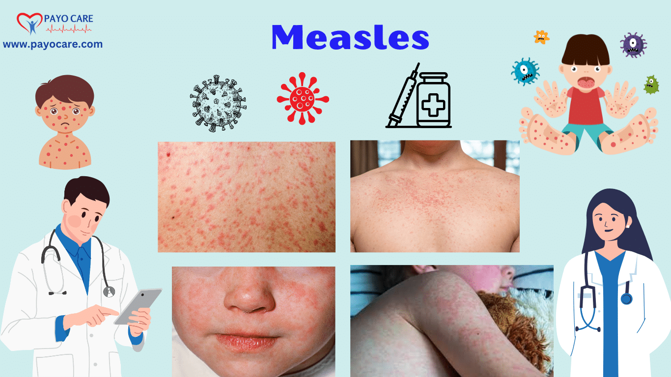 Measles: Causes, Symptoms, Prevention & Treatment - Payo Care