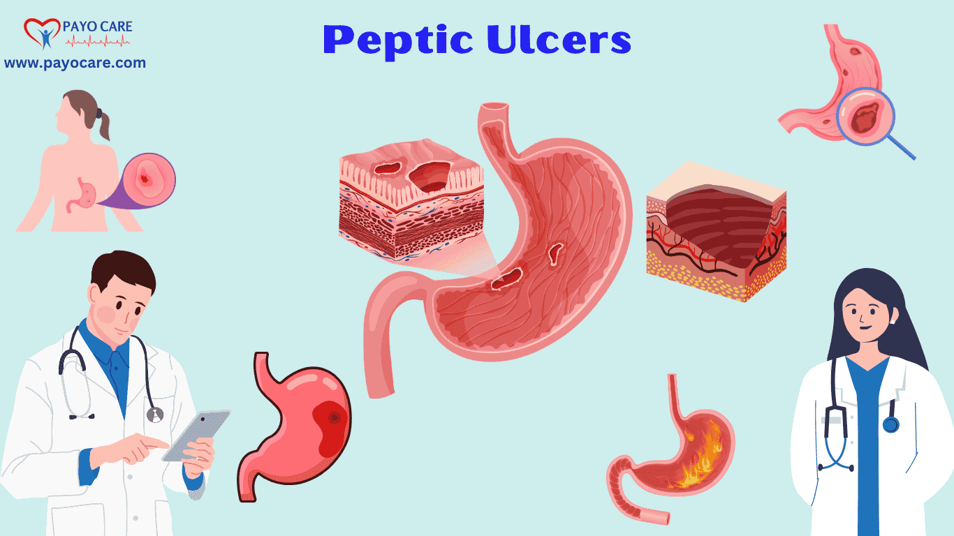 Peptic Ulcers :Causes, Symptoms & Treatment – PAYO CARE provides expert ...