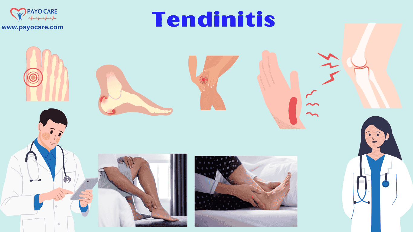 Tendinitis: Causes, Symptoms, Prevention & Treatment – PAYO CARE ...
