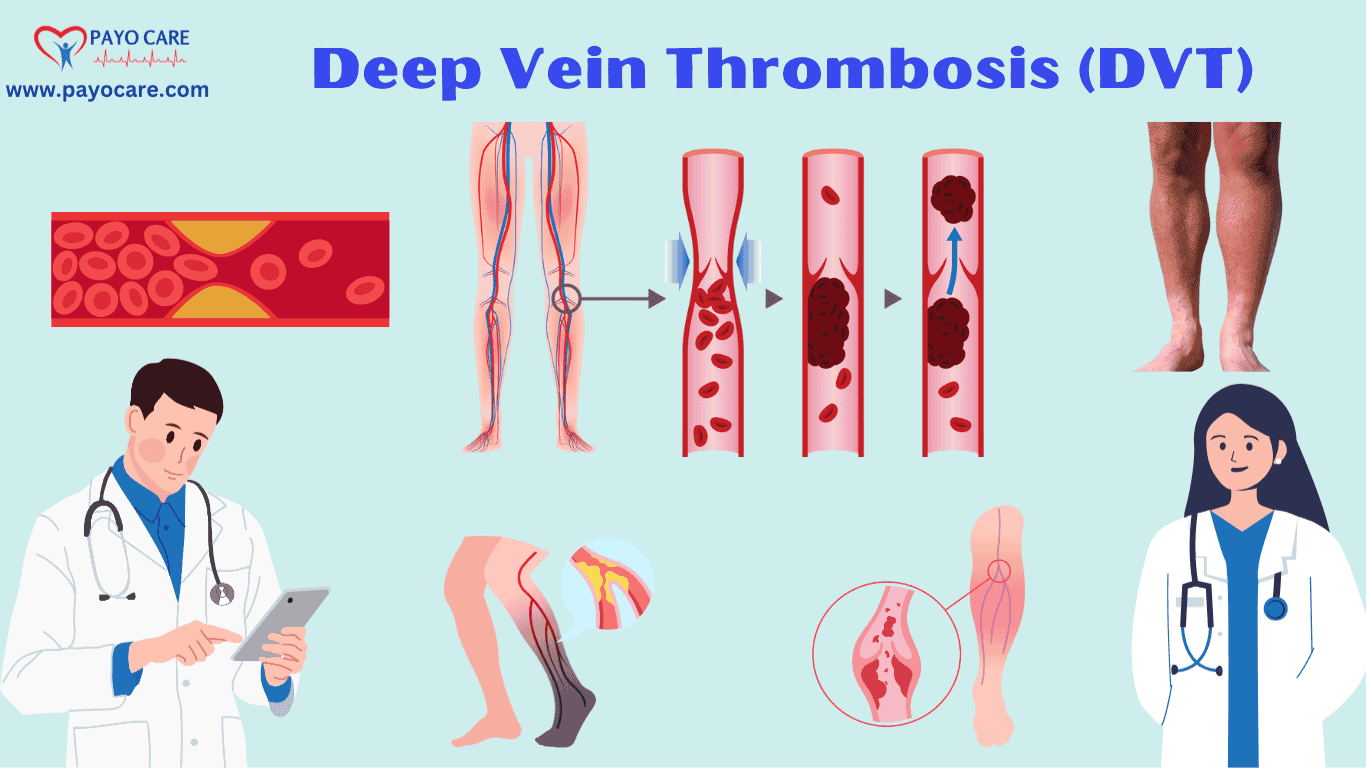Deep Vein Thrombosis (DVT): Causes, Symptoms and Treatments - Payo Care