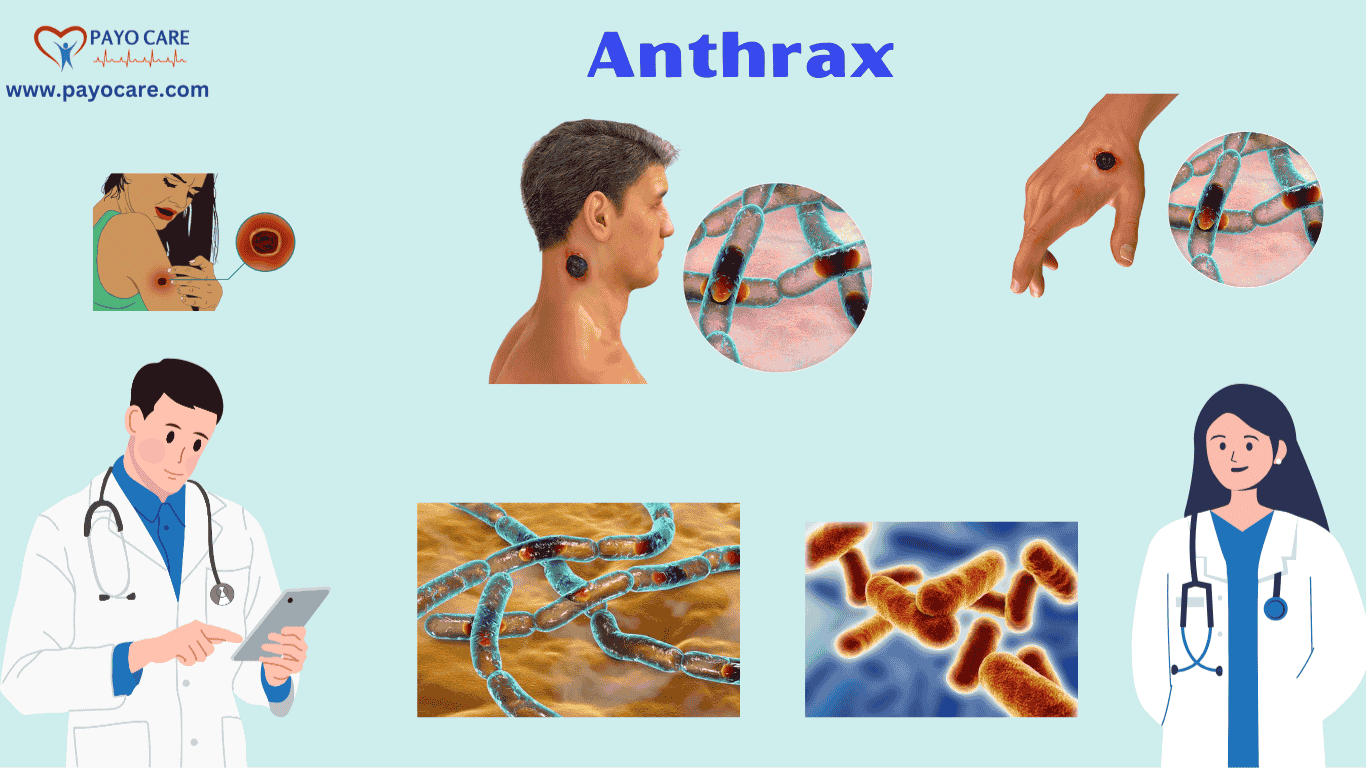 Anthrax :Causes, Symptoms and Treatment - Payo Care
