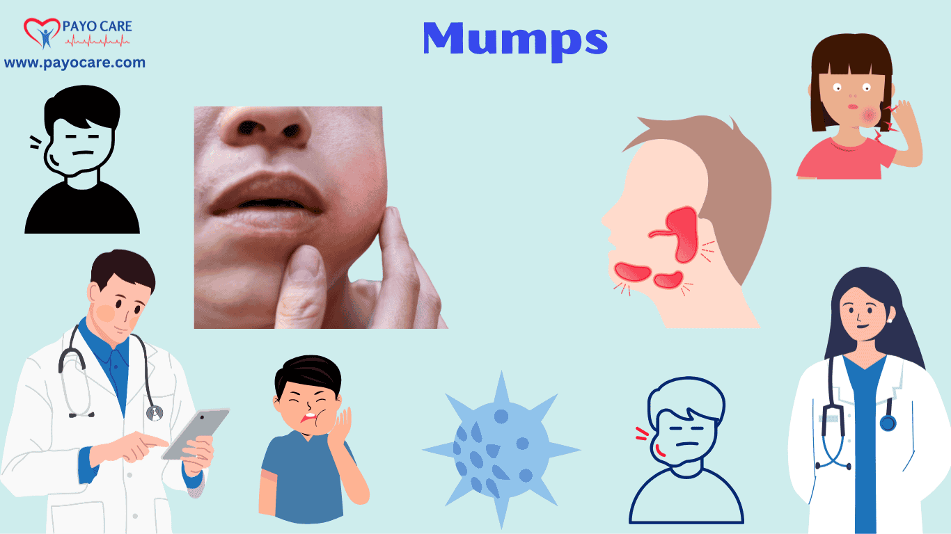 Mumps: Causes, Symptoms and Treatment – PAYO CARE provides expert ...