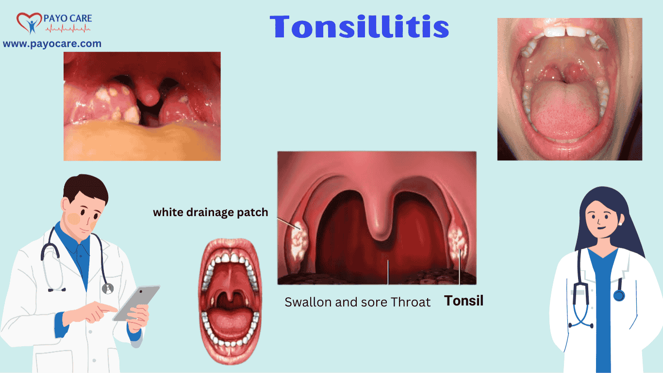 Tonsillitis: Causes, Symptoms, Preventions and Treatment - Payo Care