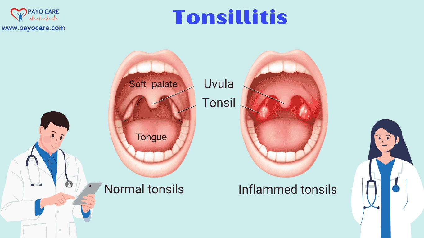Tonsillitis: Causes, Symptoms, Preventions and Treatment - Payo Care